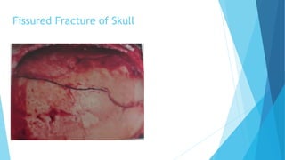 Ante-mortem and Post-mortem injuries - Copy.pdf