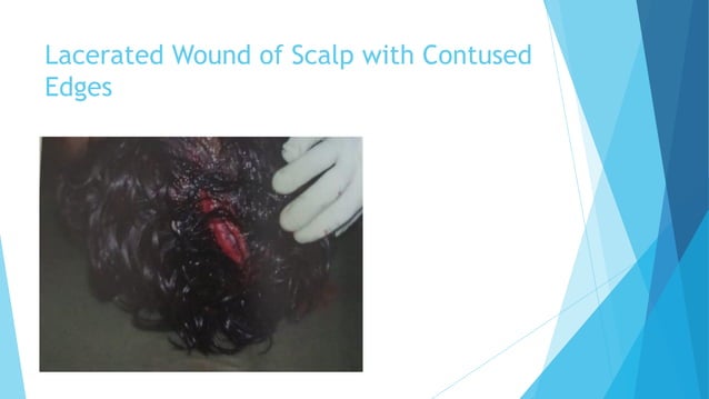 Ante-mortem and Post-mortem injuries - Copy.pdf