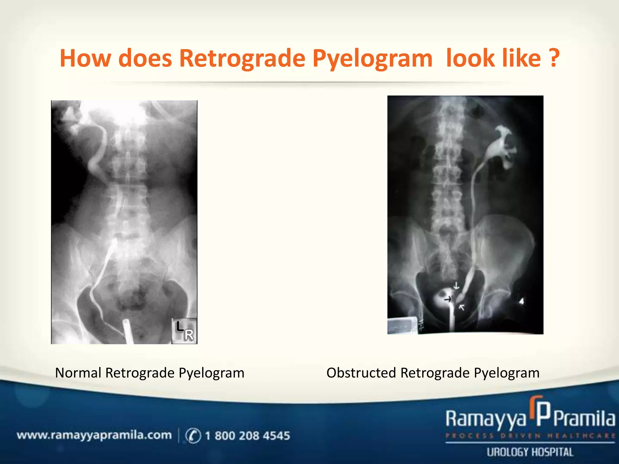 Antegrade and retrograde pyelography | PPTX