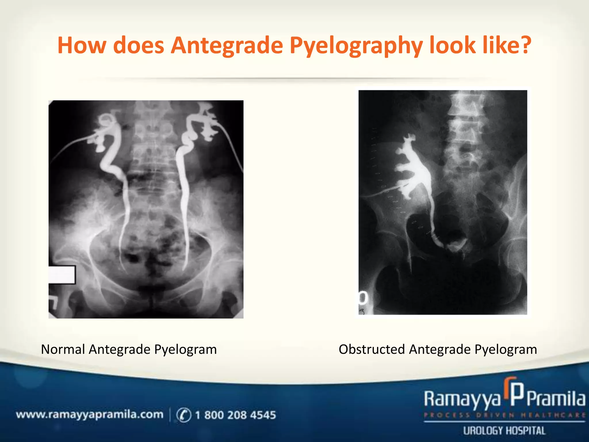 Antegrade and retrograde pyelography | PPTX