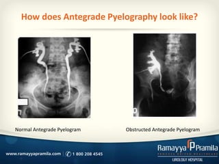 Antegrade and retrograde pyelography | PPT
