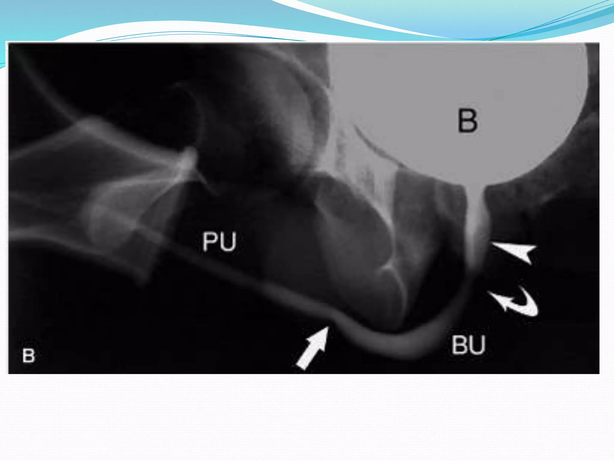 Antegrade & retrograde urethrogram | PPTX