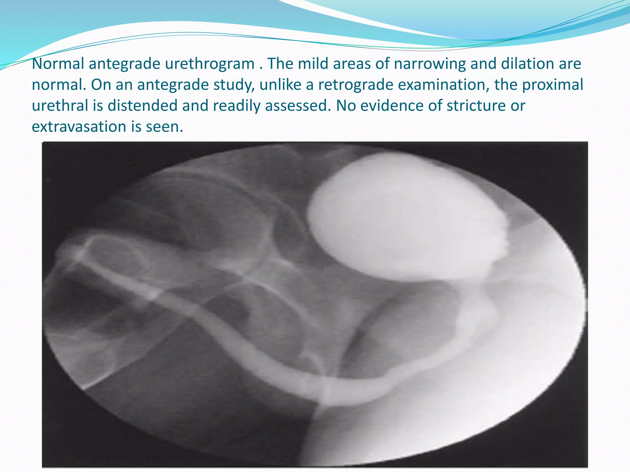 Antegrade & retrograde urethrogram | PPT Antegrade & retrograde urethrogram | PPT
