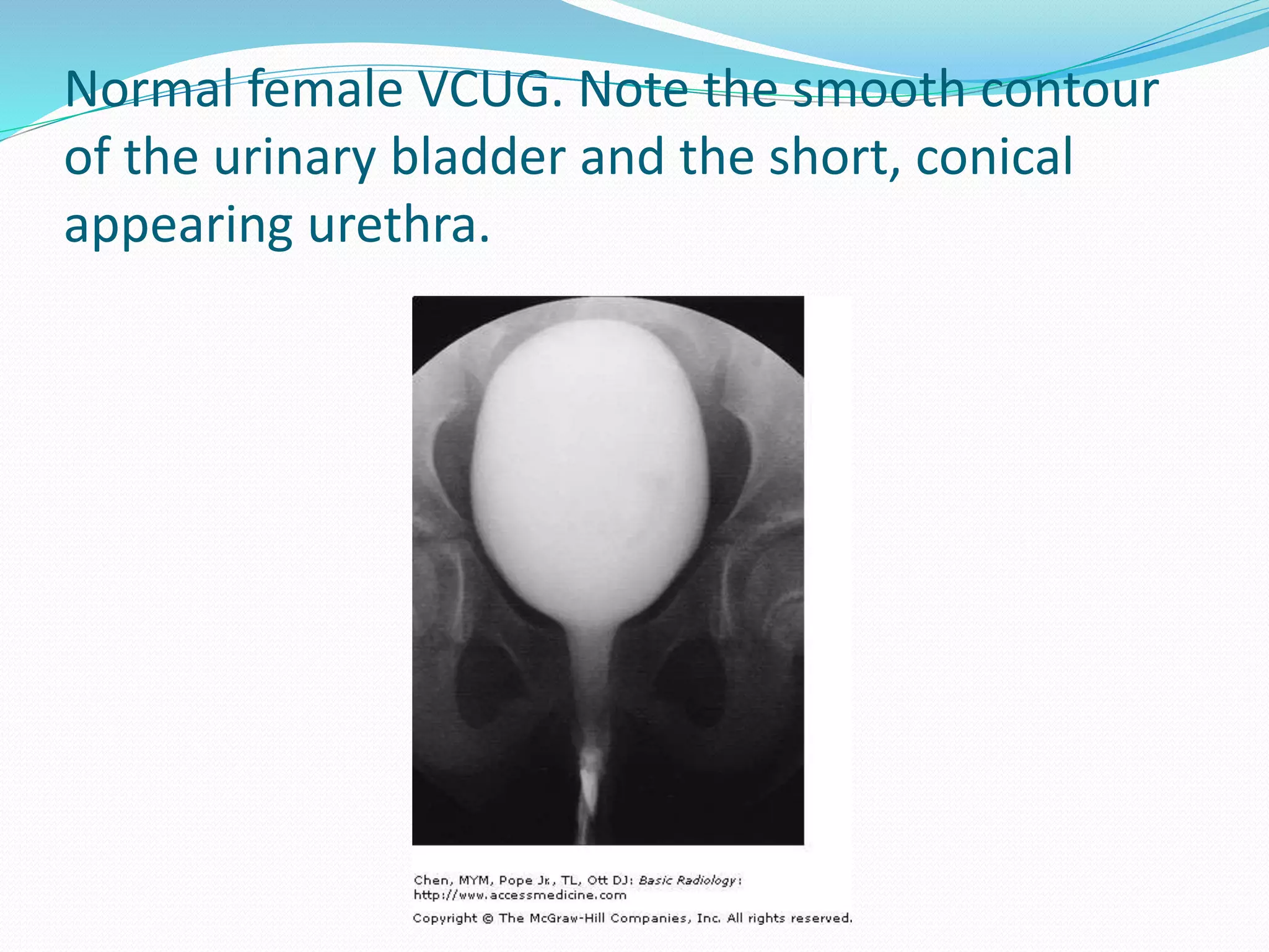 Antegrade & retrograde urethrogram | PPT Antegrade & retrograde urethrogram | PPT