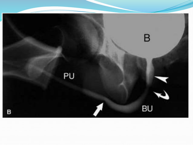 Antegrade & retrograde urethrogram | PPTX | Medical Tests | Medical Health