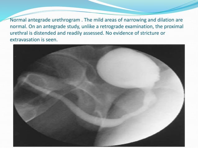 Antegrade & retrograde urethrogram | PPTX | Medical Tests | Medical Health