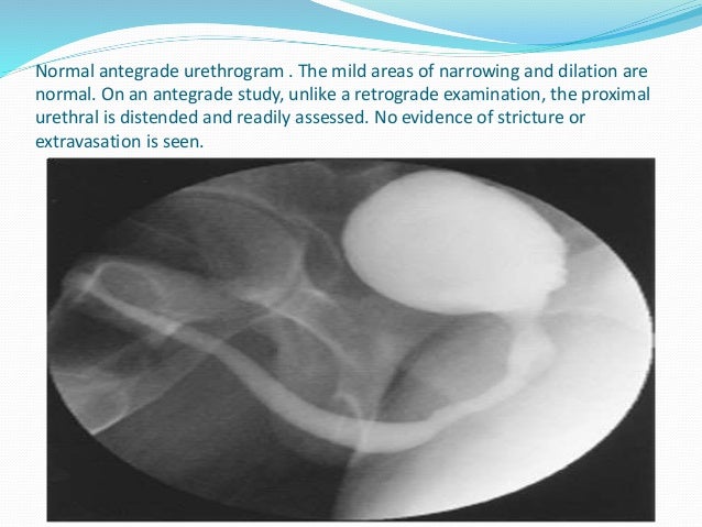 Antegrade & retrograde urethrogram