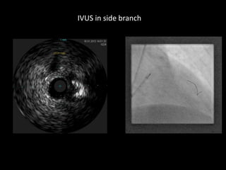 Antegrade – step by step approach | PDF