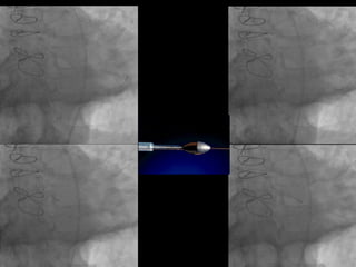 Antegrade – step by step approach | PDF