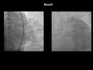 Antegrade – step by step approach | PDF