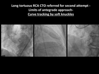 Antegrade – step by step approach | PDF