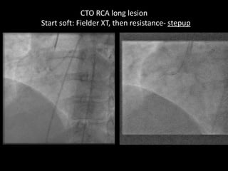 Antegrade – step by step approach | PDF
