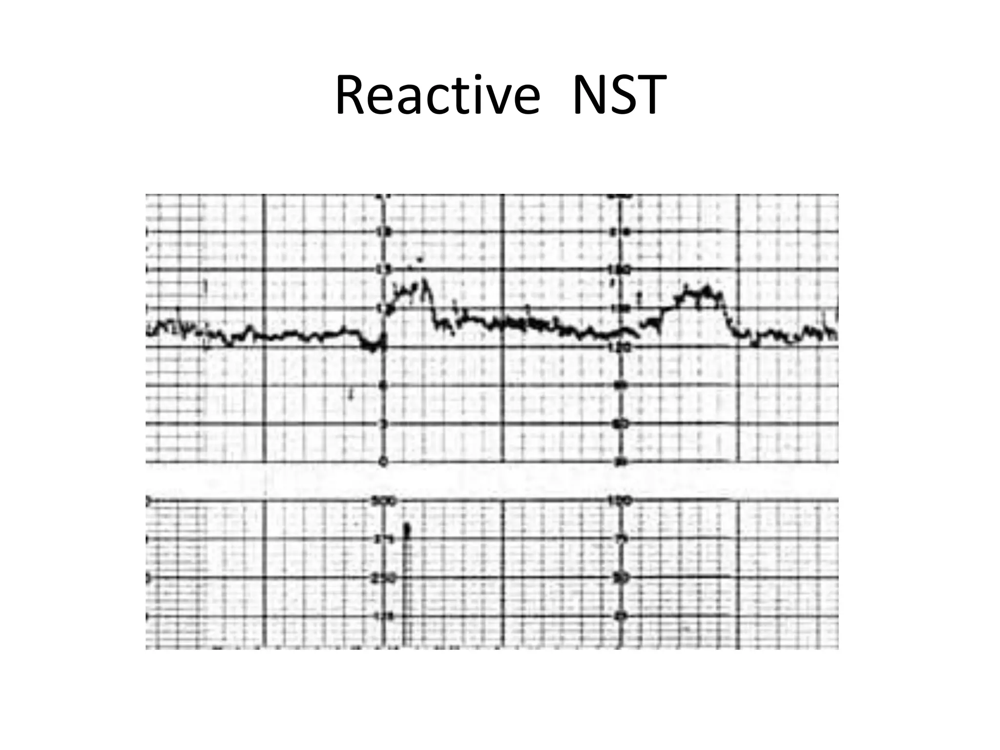 Antenatal fetal monitoring | PPTX