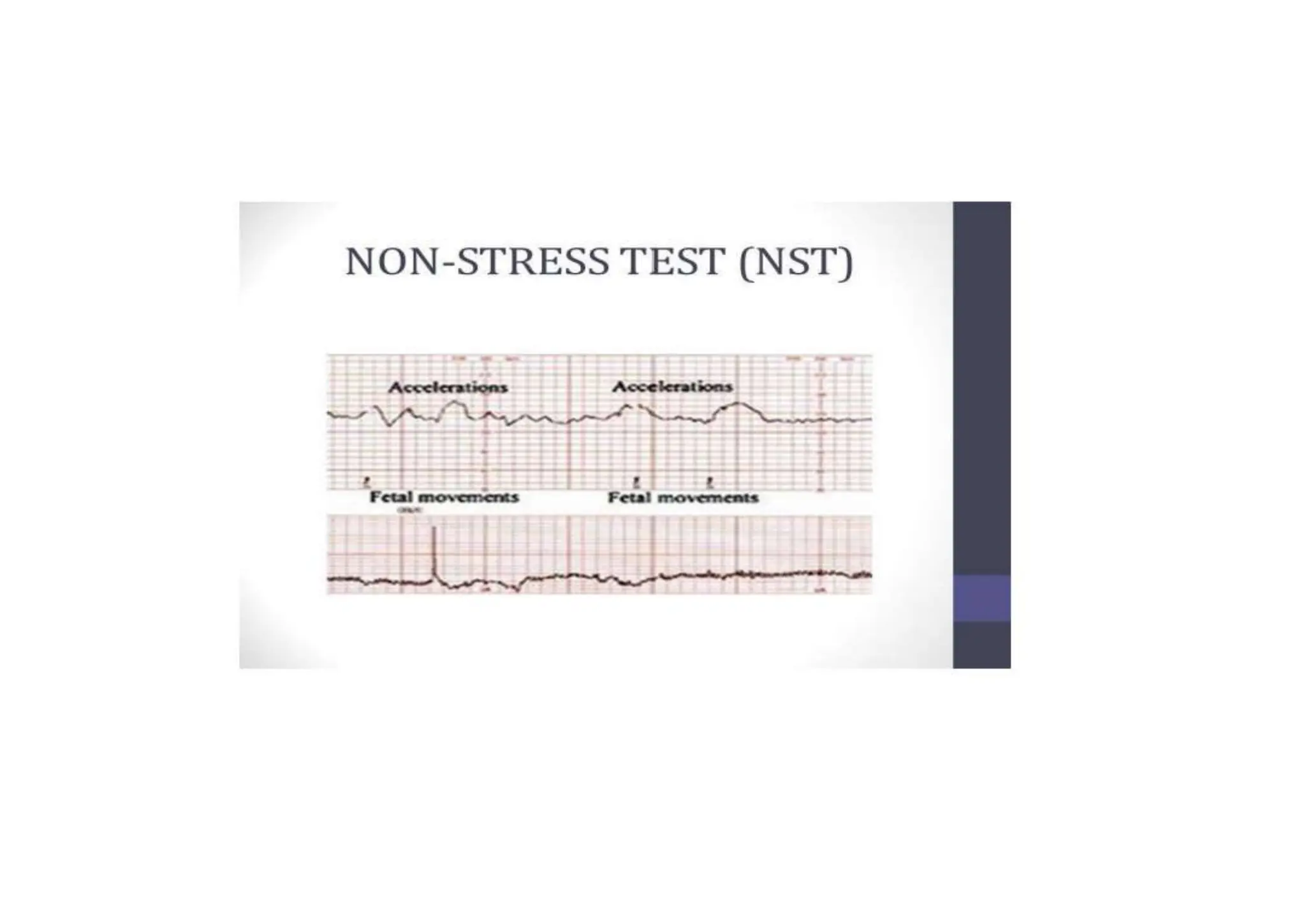 antenatal fetal surveillance obstetrics.pptx | Pregnancy | Reproductive Health
