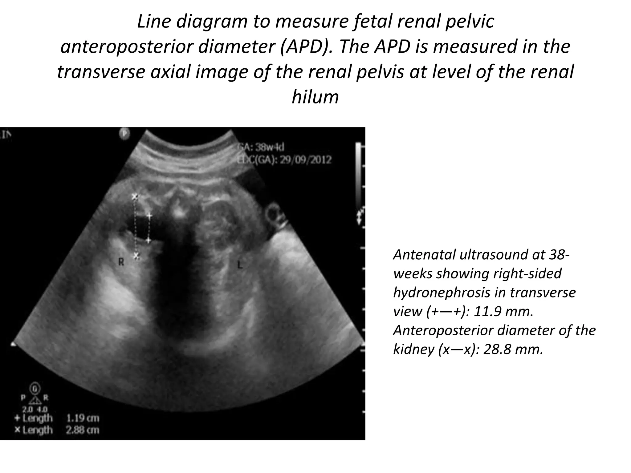 Antenatal hydronephrosis | PPTX