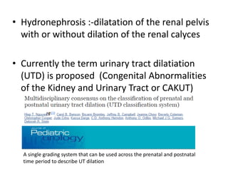 Grading System Hydronephrosis In Adults