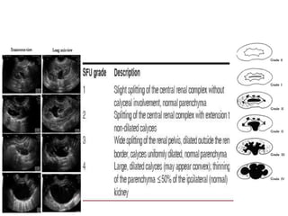 Grading System Hydronephrosis In Adults