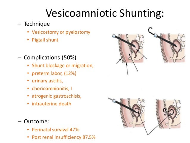Antenatal hydronephrosis