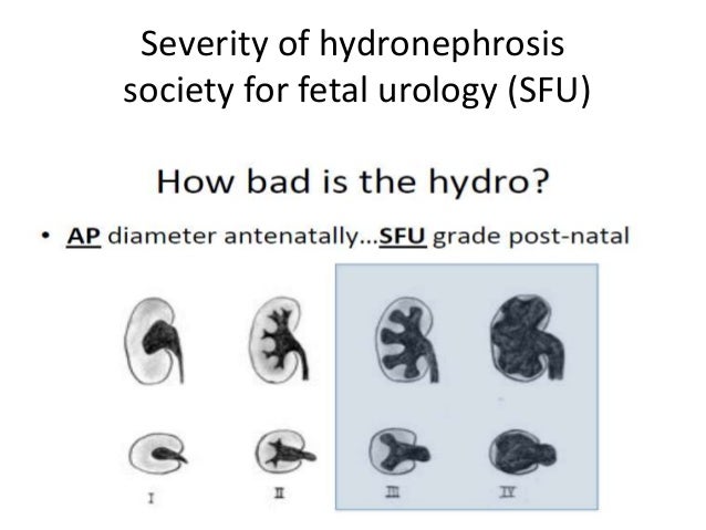 Antenatal hydronephrosis