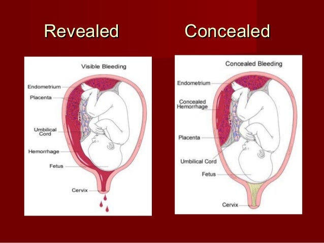 Antepartam haemorrhage