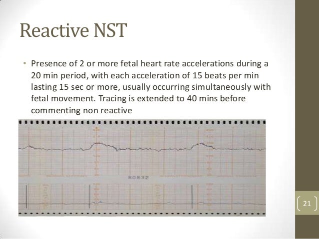 Antepartum fetal surveillance