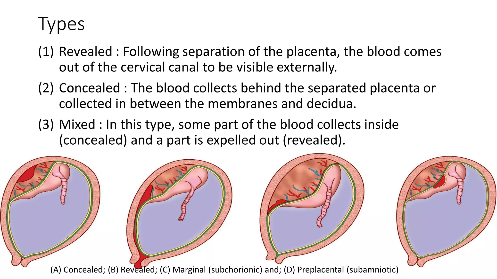Antepartum haemorrhage | PDF