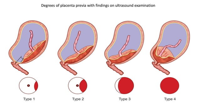 Antepartum haemorrhage