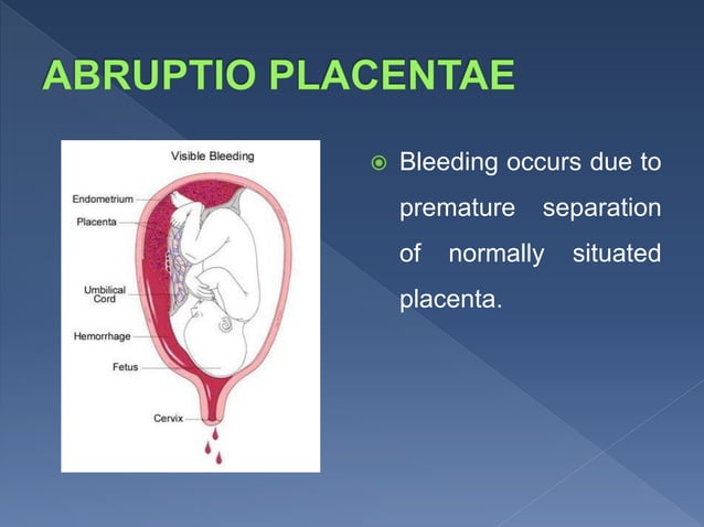 BLEEDING IN LATE PREGNANCY | PPTX