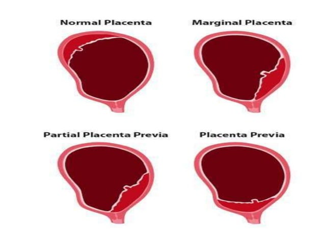 Placenta praevia.pptx
