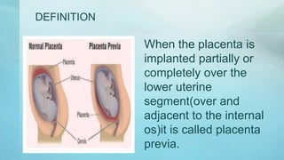 ANTEPARTUM HAEMORRHAGE.pptx