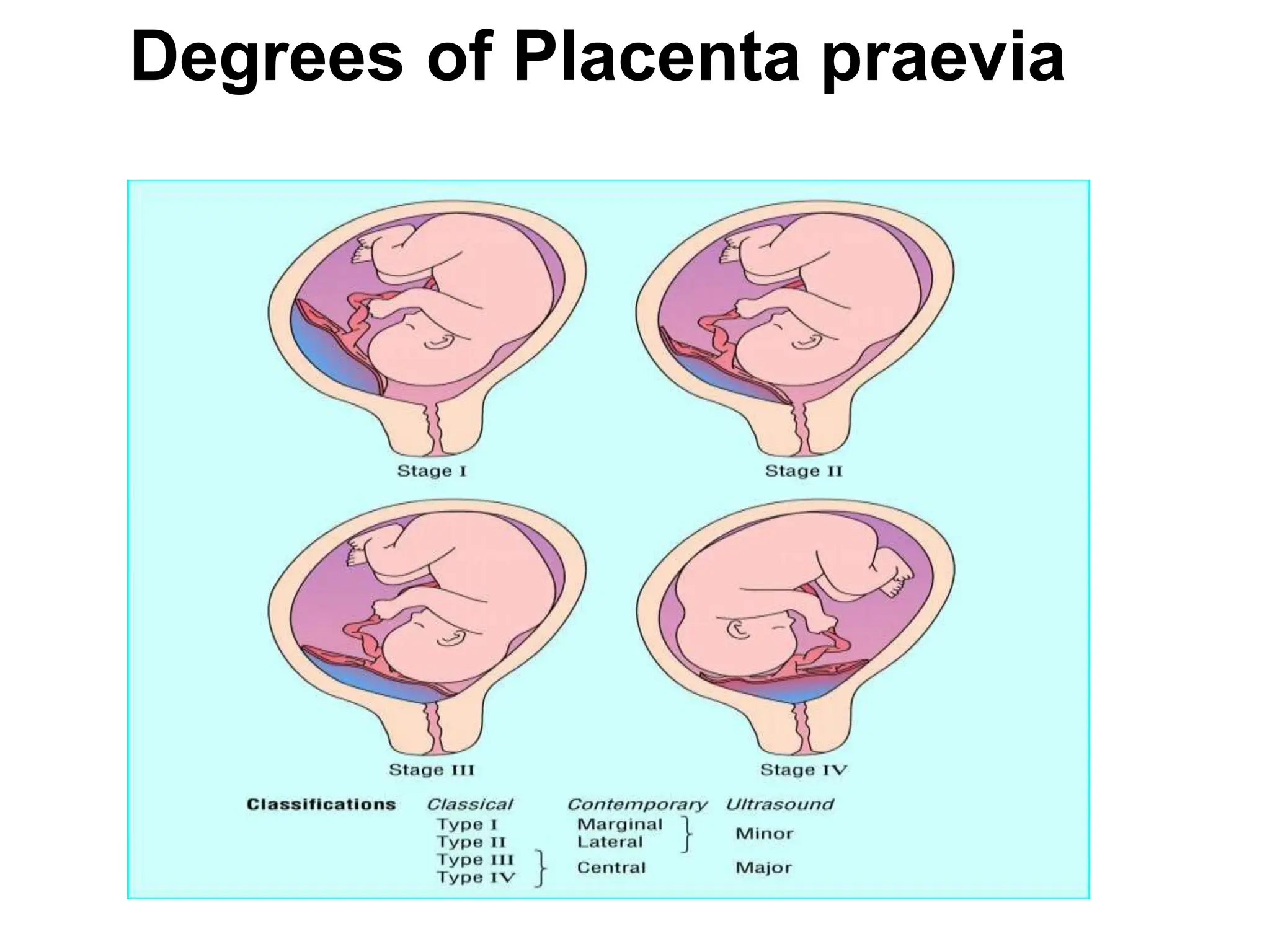 Antepartum haemorrhage, placenta previa and abruptio placentae | PPTX