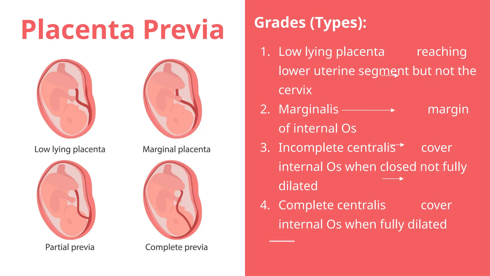 Antepartum Hemorrhage - Faculty of Nursing, Suez Canal University.pptx.pptx