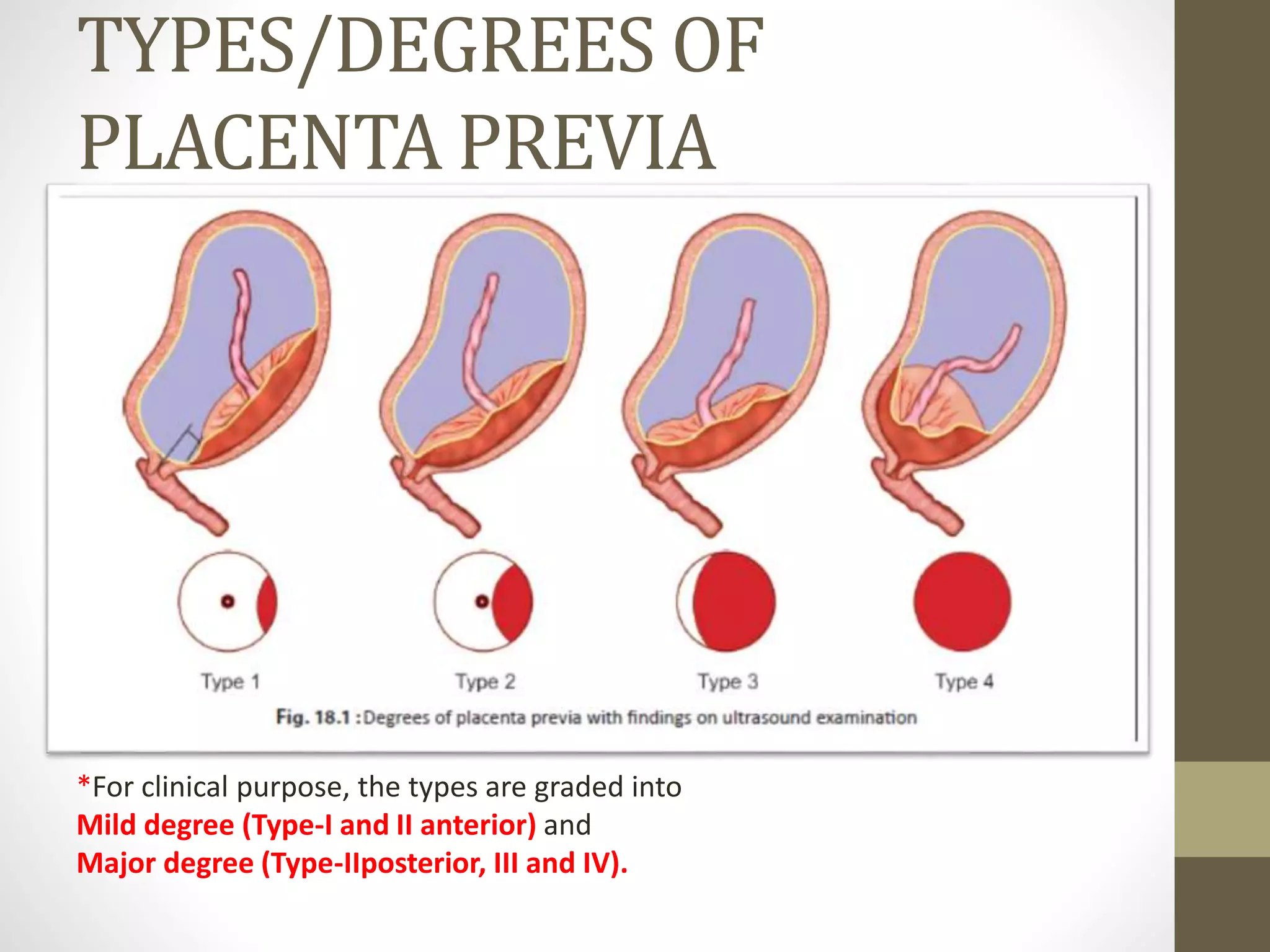 Antepartum haemorrhage i | PPTX