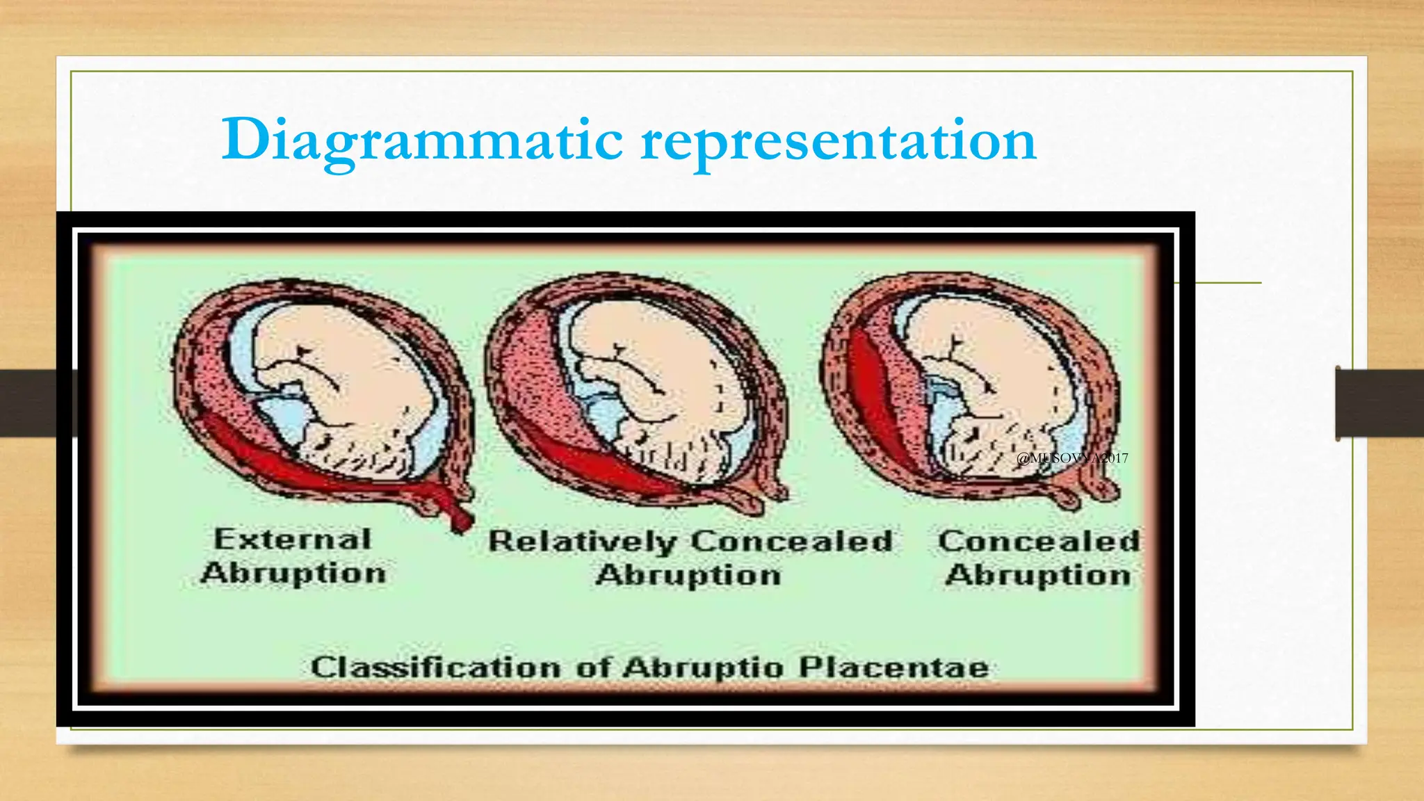 ANTEPARTUM HAEMORRHAGE (APH).pptx | Pregnancy | Reproductive Health