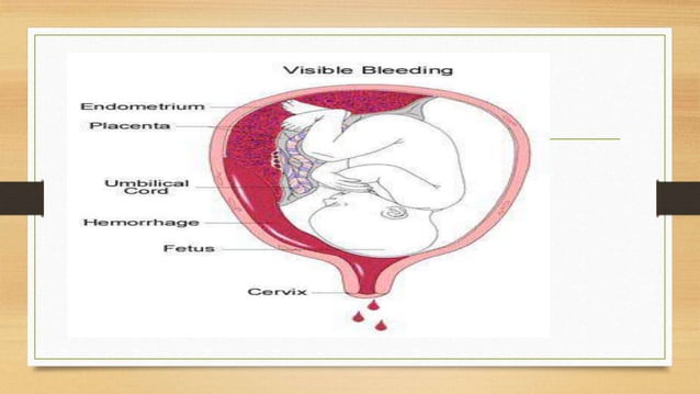 ANTEPARTUM HAEMORRHAGE (APH).pptx | Pregnancy | Reproductive Health