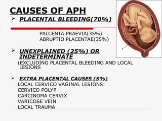 ANTEPARTUM HAEMORRHAGE PPT FOR BSC 4TH YEART .ppt