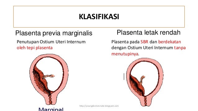 Antepartum hemorrhage