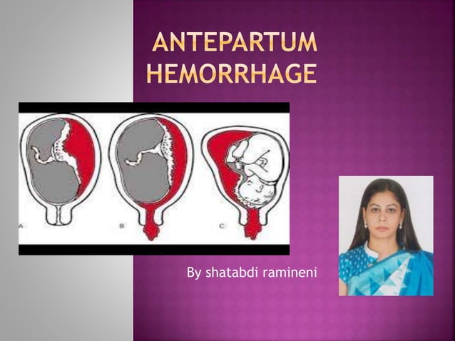 antepartum hemorrhage.pptx