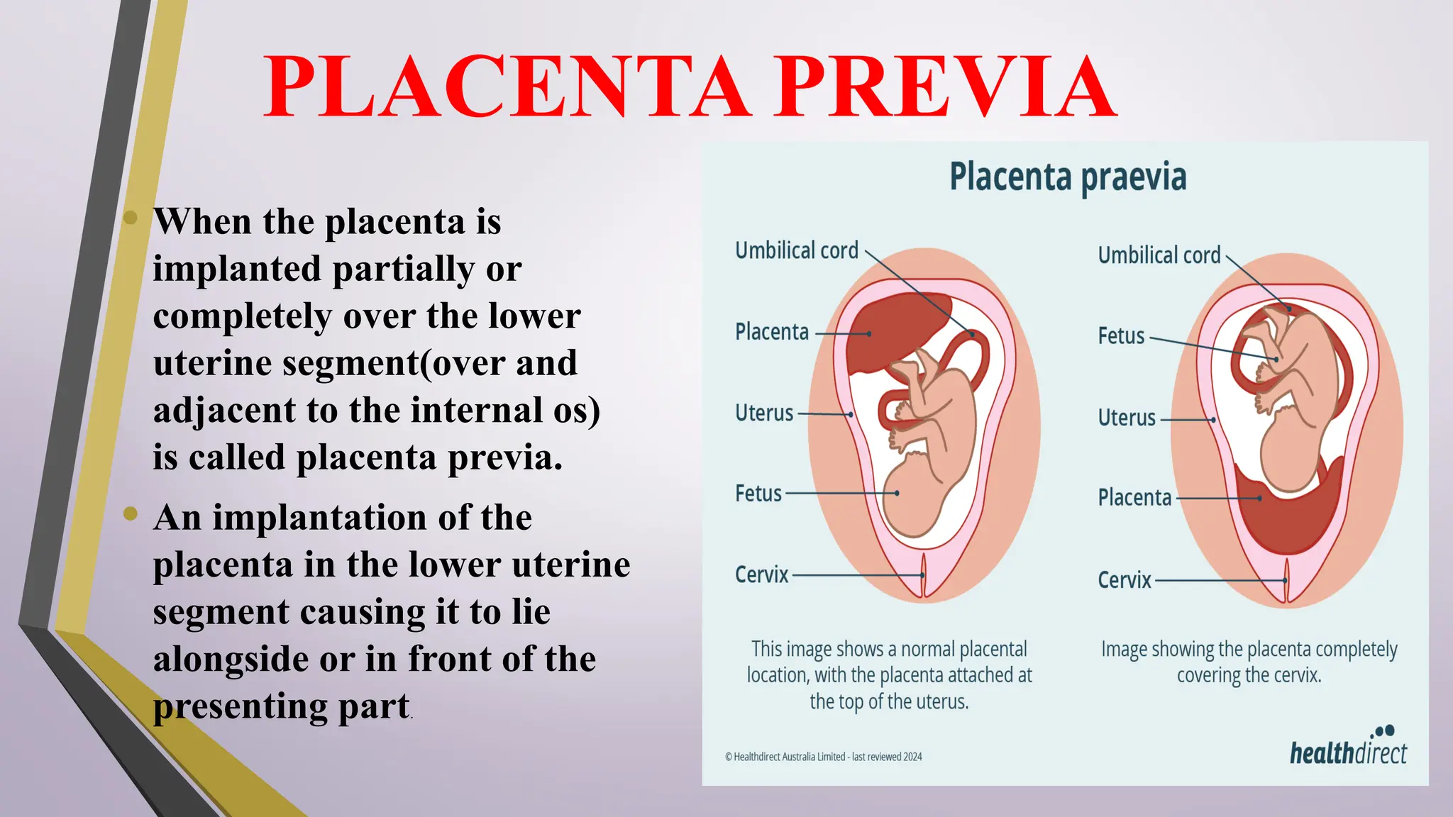 ANTEPARTUM HEMORRHAGE | PPTX
