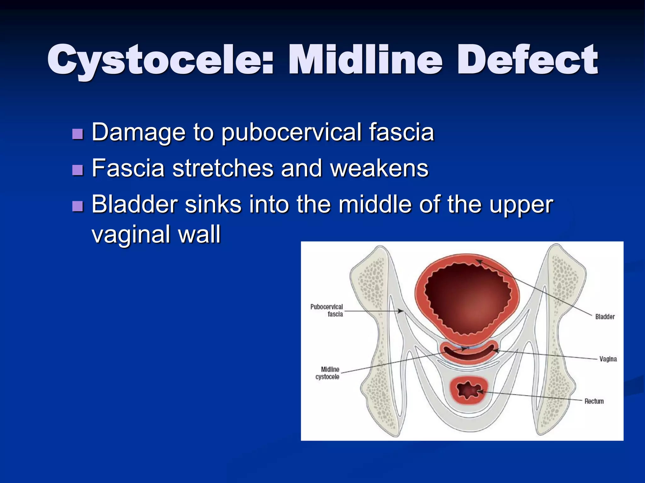 Anterior Compartment Prolapse: Biological Grafts | PDF