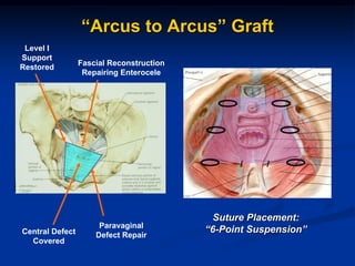 Anterior Compartment Prolapse: Biological Grafts | PDF