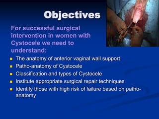 Cystocele Midline