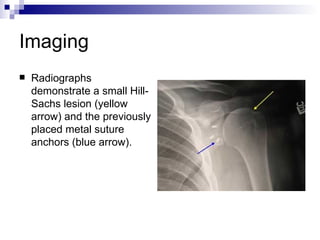 Anterior Glenohumeral Instability | PPT
