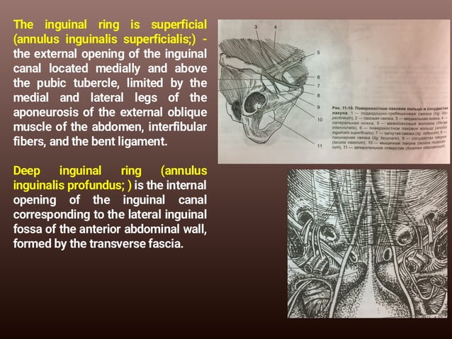 Topographic anatomy and operative ANTERIOR-LATERAL ABDOMINAL HERNIAS | PPT