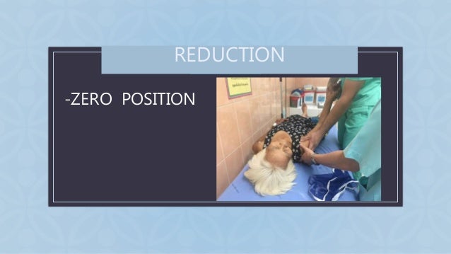 Anterior shoulder-dislocation