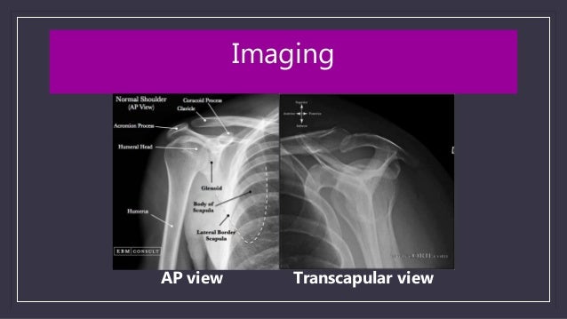Anterior shoulder-dislocation