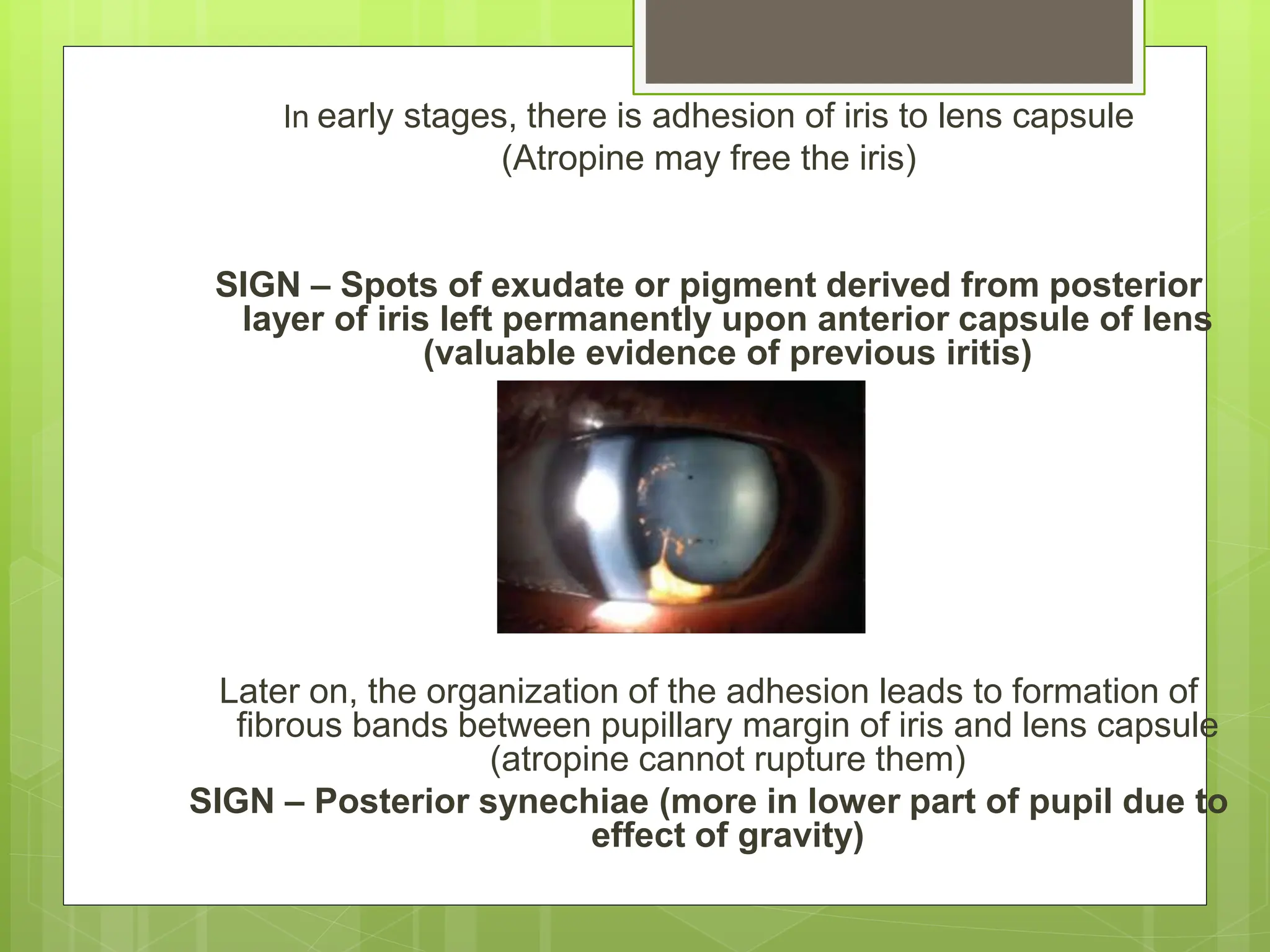 _Anterior-Uveitis.pptx ,,,,,,,,,,,,,,,,, | PPTX