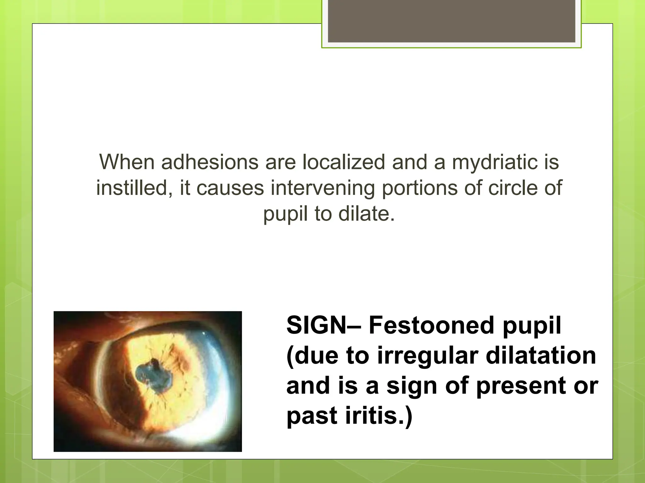 _Anterior-Uveitis.pptx ,,,,,,,,,,,,,,,,, | PPTX