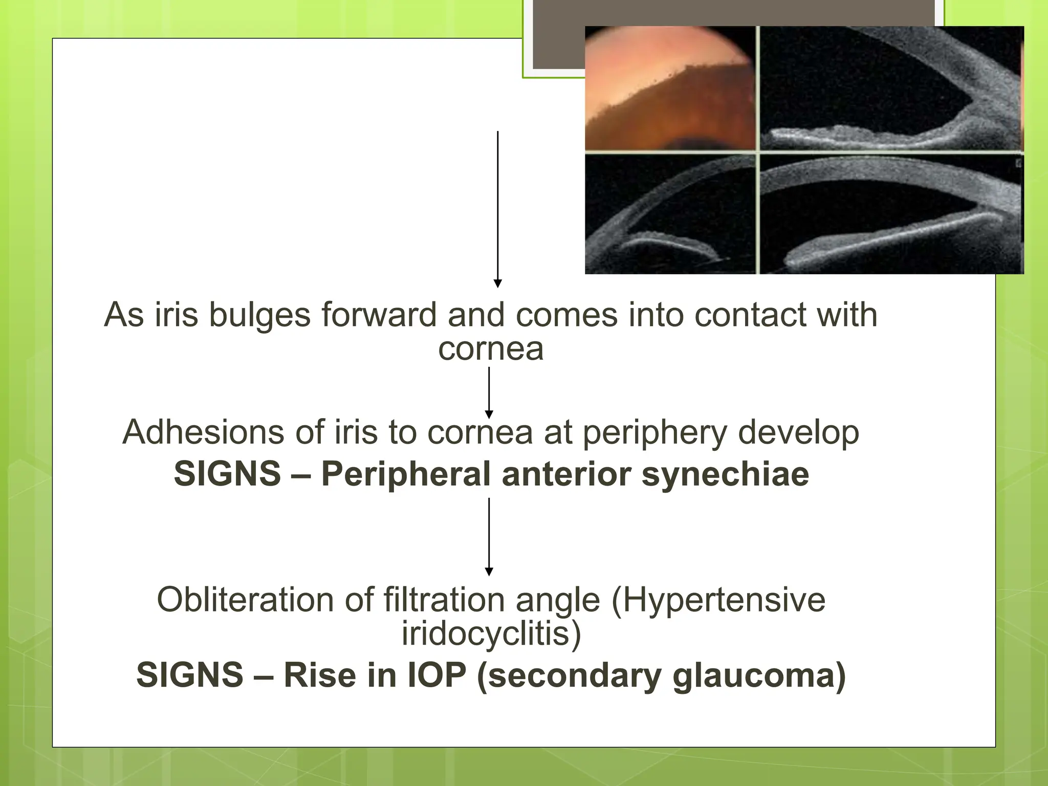 _Anterior-Uveitis.pptx ,,,,,,,,,,,,,,,,, | PPTX