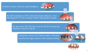 anterior aesthetic crown.anterior aesthetic crown. | PPTX